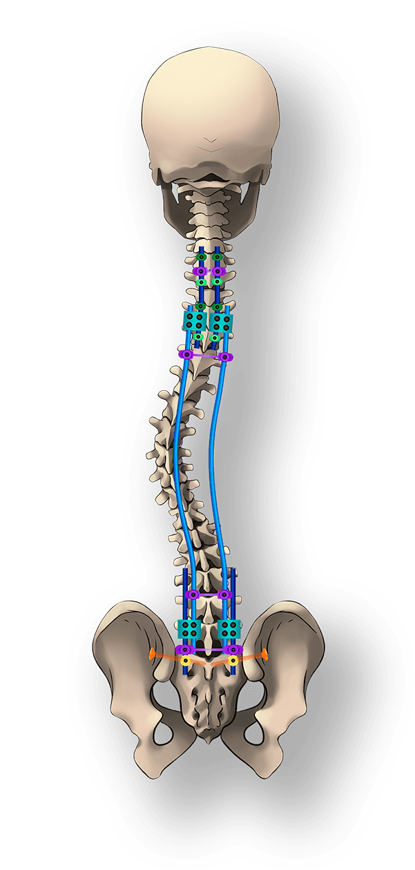 Cirurgia de escoliose inédita no Brasil é realizada no Hospital ...